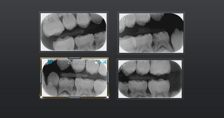 Bitewing bilateral - Odonto Imax
